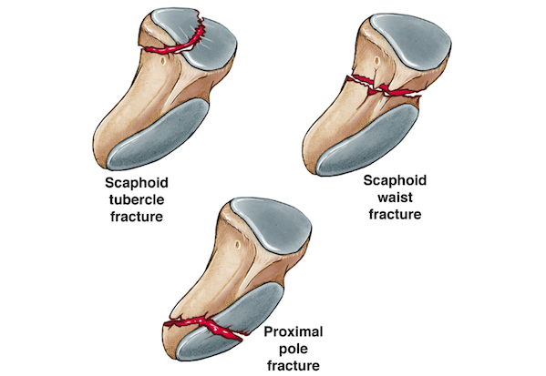 Scaphoid fracture